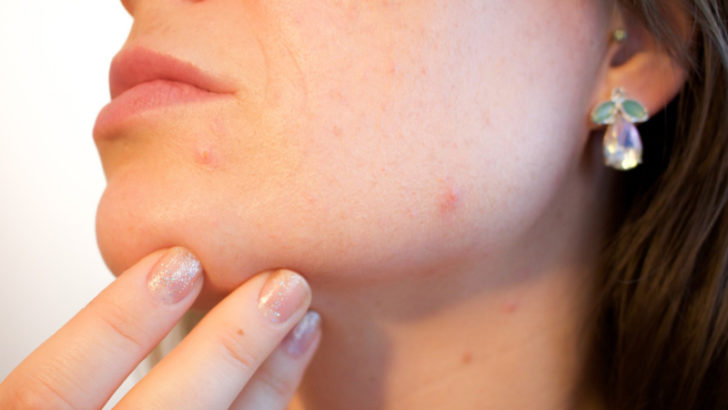 Pickel: Wie entsteht und was verursacht ein Pickel?